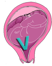 Cerclage définitif du col de l'utérus (cerclage de Benson)